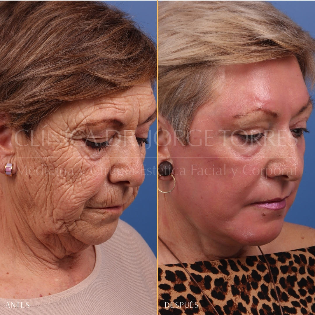 DEEP PLANE es Rejuvenecimiento Facial Clínica de Jorge Torres